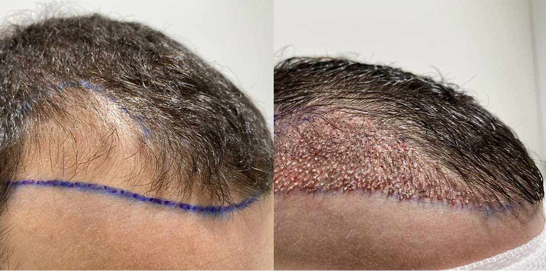 L'évolution d'une greffe de cheveux mois par mois - Hair Turkey