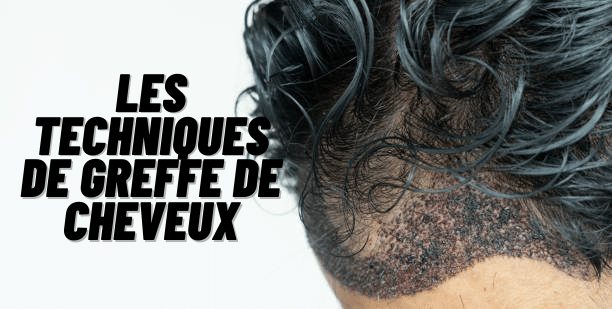Les différentes techniques de greffe de cheveux : à savoir